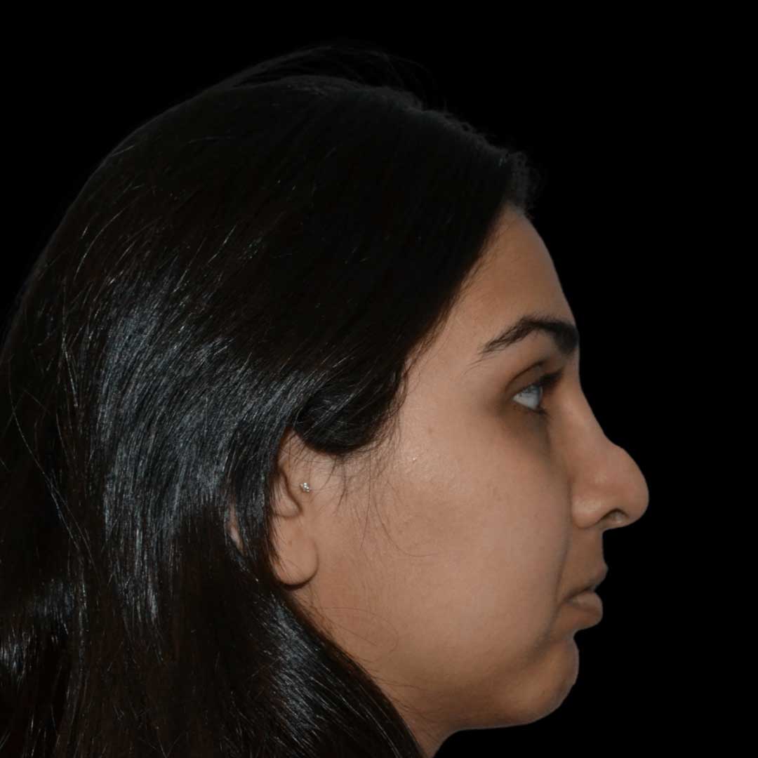 2 Prior Rhinoplasty Surgeries Interview | Plastic Surgery of Shorthills