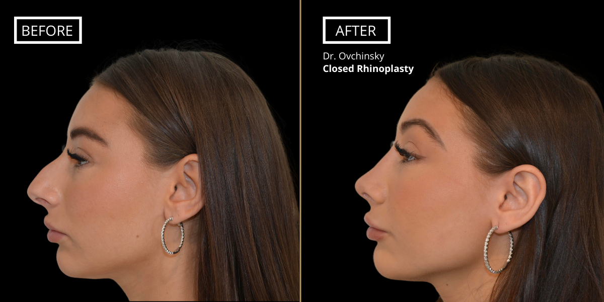 Best Open Vs. Closed Rhinoplasty- Should I get an open or closed ...