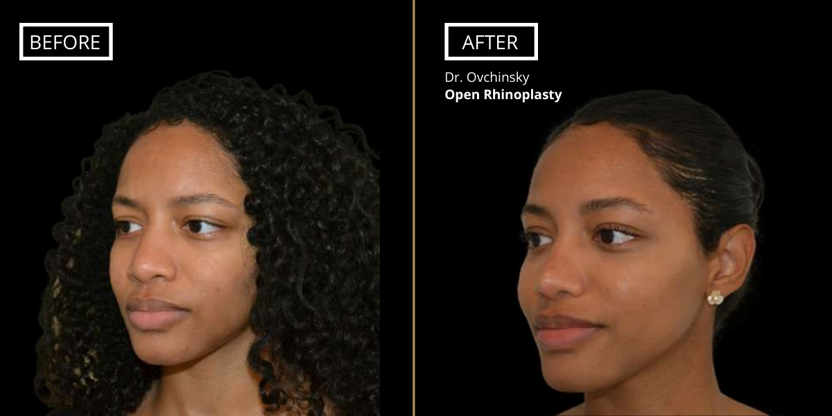 Best Open Vs. Closed Rhinoplasty- Should I get an open or closed ...