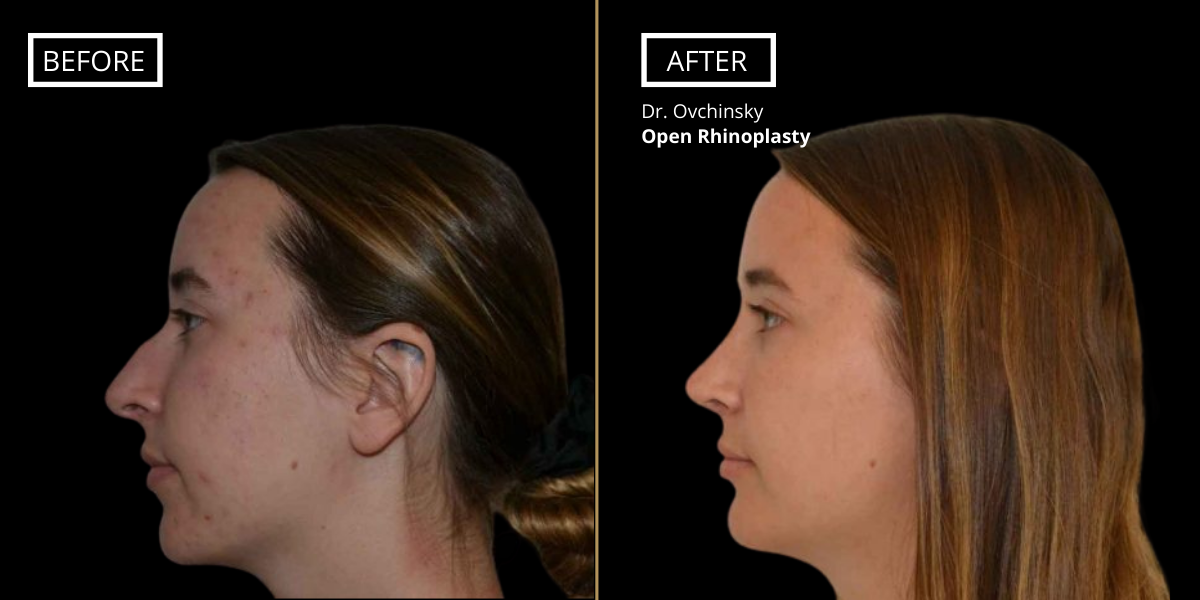 Best Open Vs. Closed Rhinoplasty- Should I get an open or closed ...