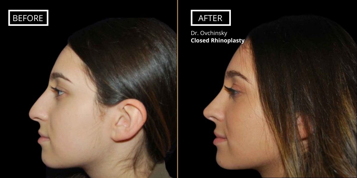 Best Open Vs. Closed Rhinoplasty- Should I get an open or closed ...