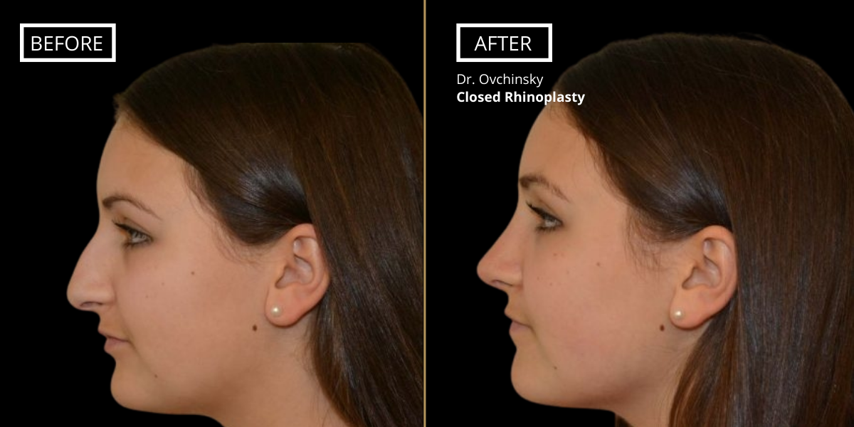 Best Open Vs. Closed Rhinoplasty- Should I get an open or closed ...