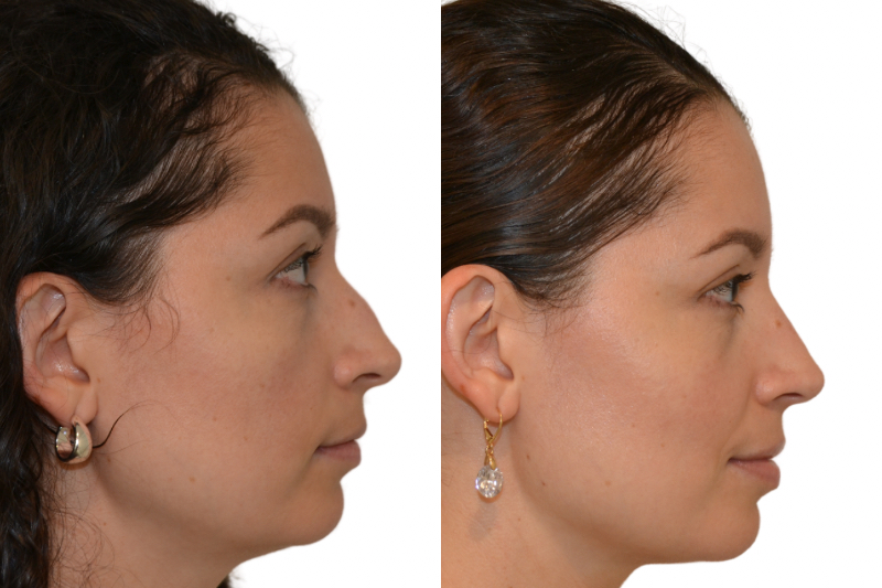 Best Ethnic Rhinoplasty New Jersey, New York | Plastic Surgery of Short ...