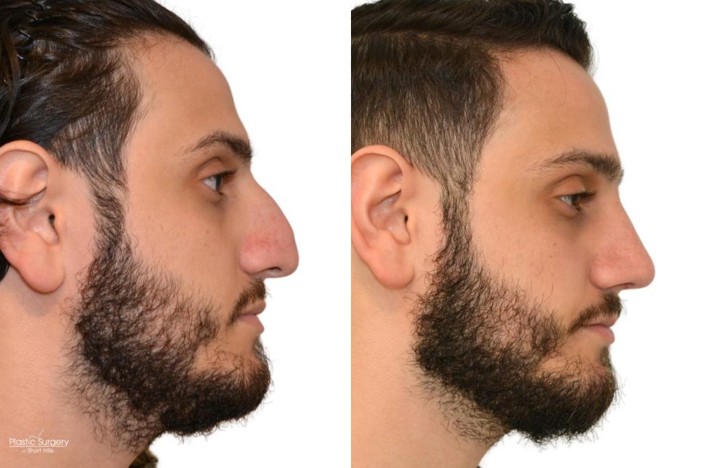 Best Male Rhinoplasty New Jersey, New York | Plastic Surgery of Short Hills