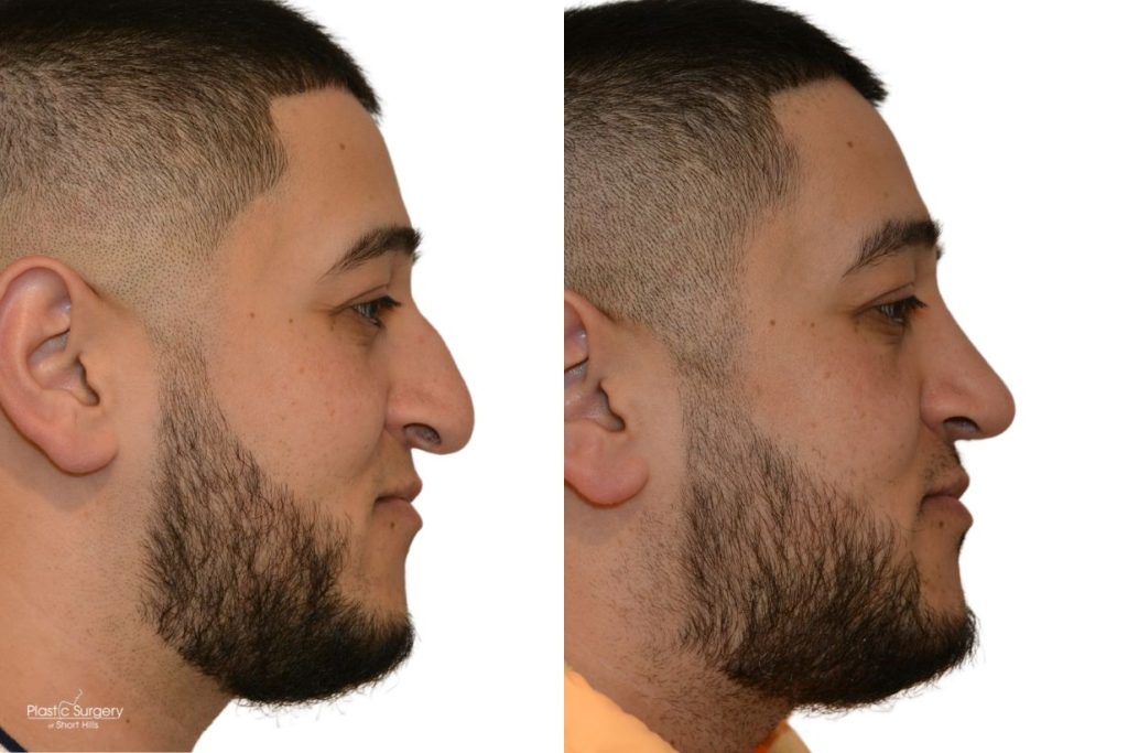Best Male Rhinoplasty New Jersey, New York | Plastic Surgery of Short Hills